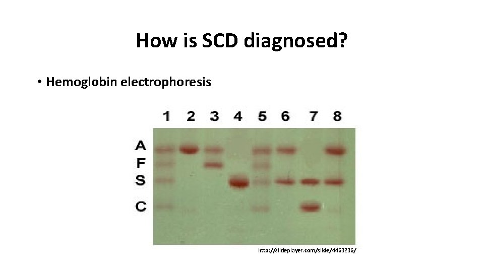 Sickle Cell Disease Emily S Moses M D