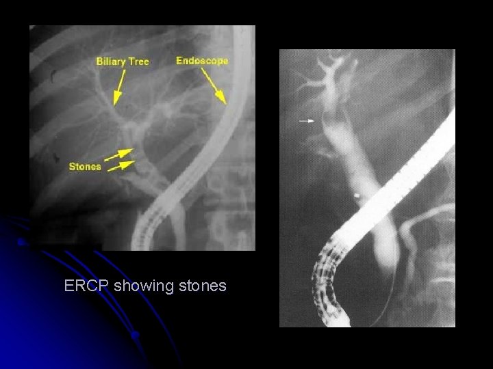Imaging in Surgical Obstructive Jaundice Dr Himadri Sikhor