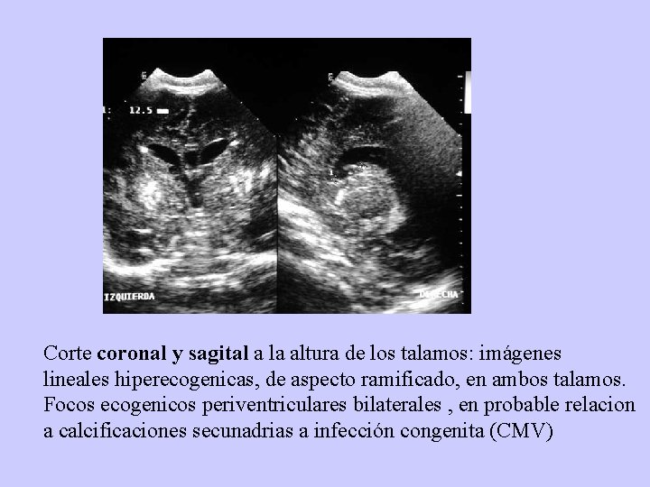 VASCULOPATIA LENTICULOESTRIADA ECOGRAFIA CEREBRAL NEONATAL VASCULOPATIA ...