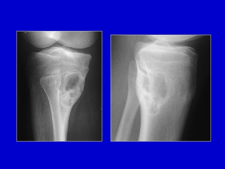 Fibrome non ossifiant Lacune corticale mtaphysaire cortical defect