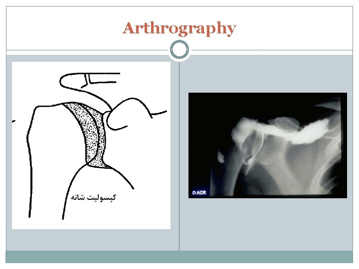 Periarthritis Of Shoulder Joint DR M ABBASI RHEUMATOLOGIST