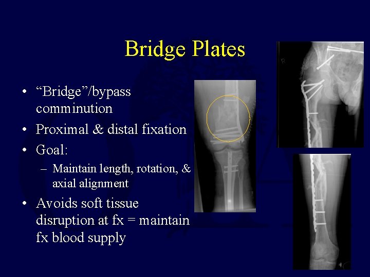 Basic Principles and Techniques of Internal Fixation of