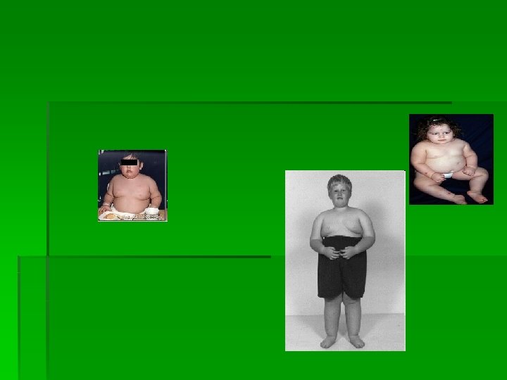 SINDROMI SINDROME DI ANGELMAN Nel 1965 Harry Angelman