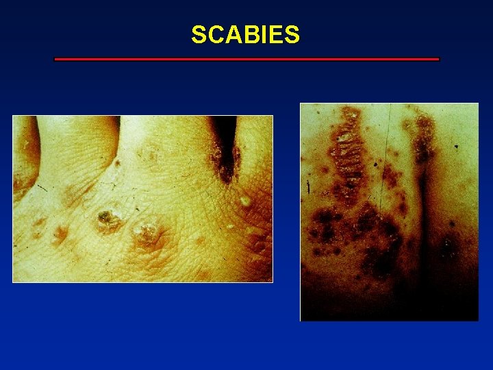 SCABIES LICE AND HPV Michael E Hagensee M