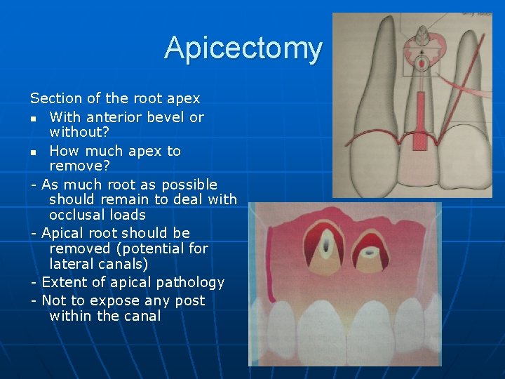 Acute Alveolar Osteitis Dr Ashraf Abu Karaky Assistant