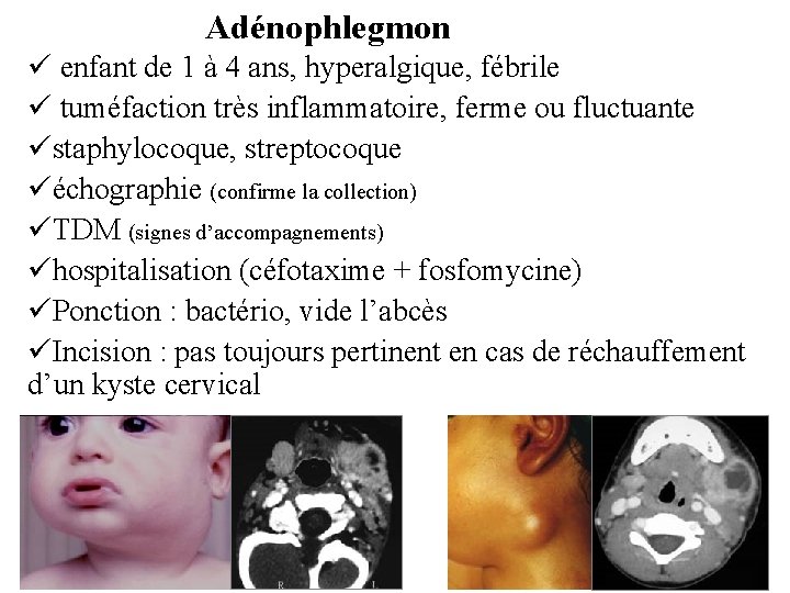 Infections de la sphre ORL aux urgences Complications