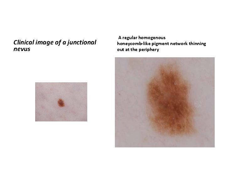 Dermoscopy Colors Depending on the anatomic location and