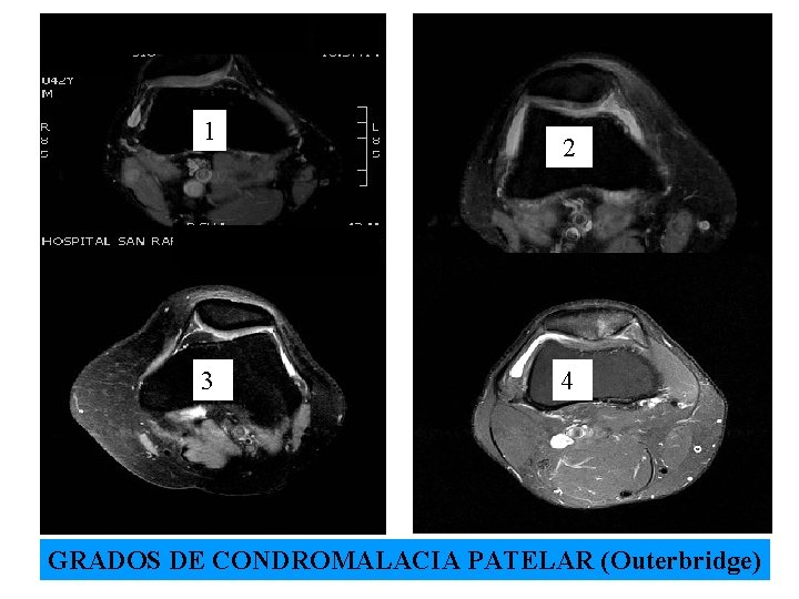 MORFOLOGA ROTULIANA WIBERG II II 65 10 III
