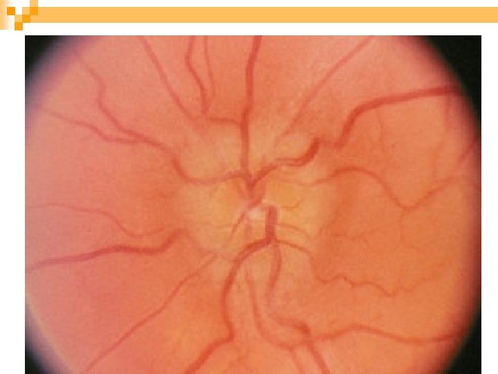 Anterior ischemic optic neuropathy AION Most common over