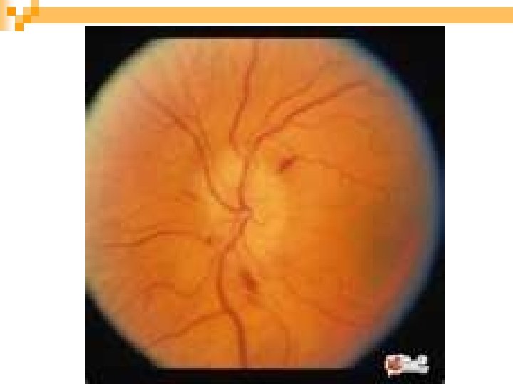 Anterior ischemic optic neuropathy AION Most common over