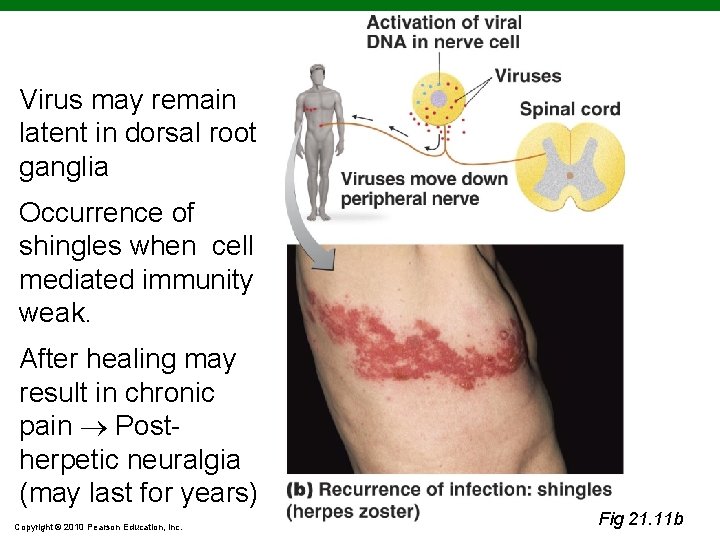 Chapter 21 Microbial Diseases of the Skin and