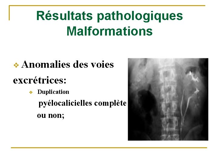 Radiographie contraste Ralis par Dr Badis Urographie intraveineuse