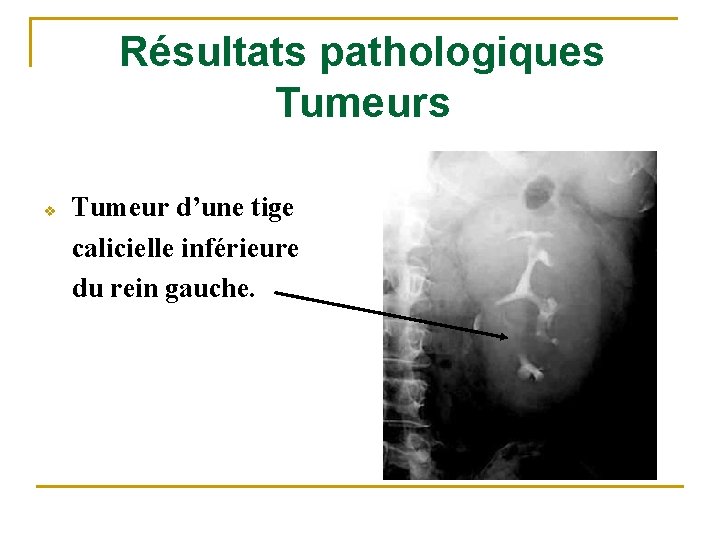 Radiographie contraste Ralis par Dr Badis Urographie intraveineuse