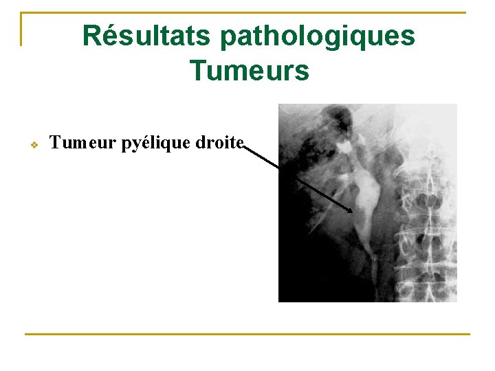 Radiographie contraste Ralis par Dr Badis Urographie intraveineuse