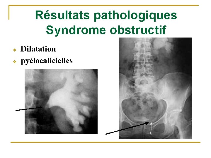 Radiographie contraste Ralis par Dr Badis Urographie intraveineuse
