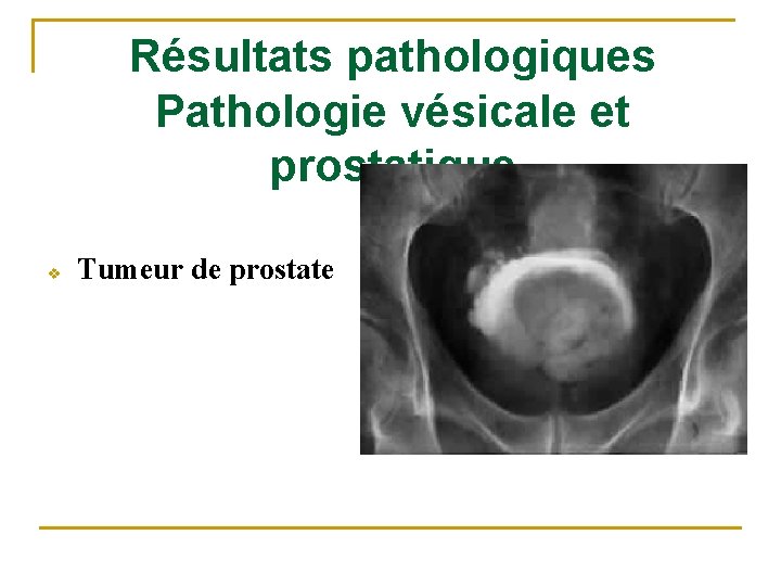 Radiographie contraste Ralis par Dr Badis Urographie intraveineuse