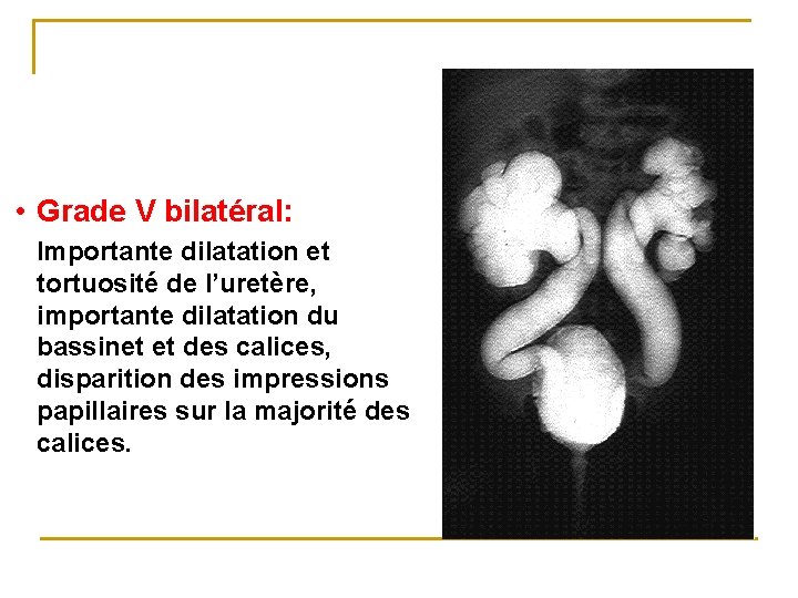 Radiographie contraste Ralis par Dr Badis Urographie intraveineuse