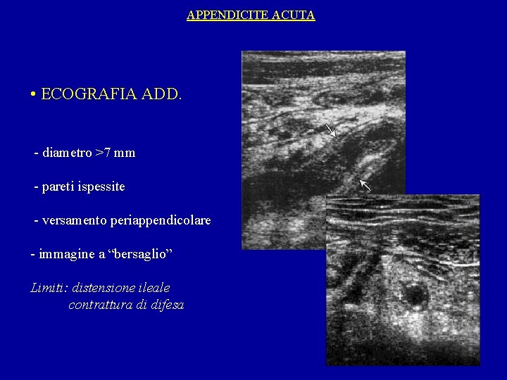 APPENDICITE ACUTA ANATOMIA Sottile condotto cilindrico Lunghezza variabile