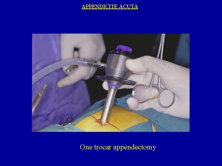 APPENDICITE ACUTA ANATOMIA Sottile condotto cilindrico Lunghezza variabile