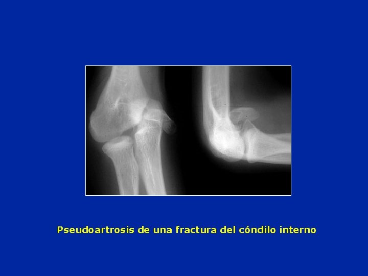 Fracturas del Codo Fracturas distales del Hmero Supracondlea