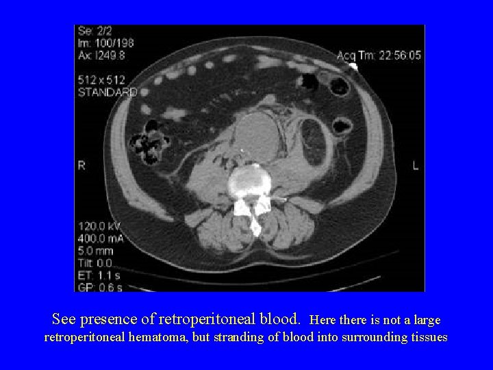 Ruptured Abdominal Aortic Aneurysms Eliza Long Treatment of