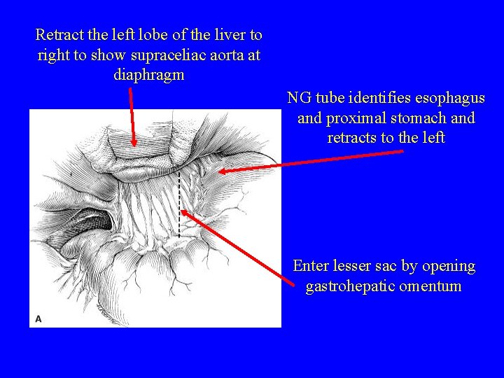 Ruptured Abdominal Aortic Aneurysms Eliza Long Treatment of