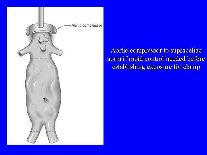 Ruptured Abdominal Aortic Aneurysms Eliza Long Treatment of