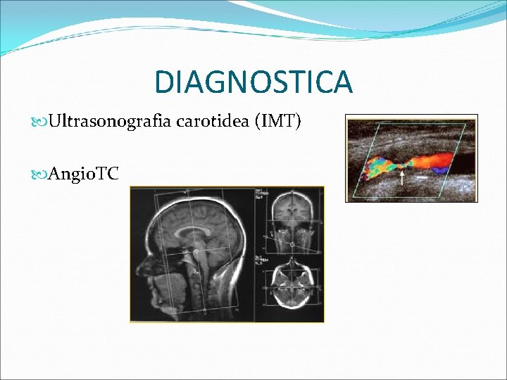 MACROANGIOPATIA E MICROANGIOPATIA DIABETICA Prof ssa M Cilli