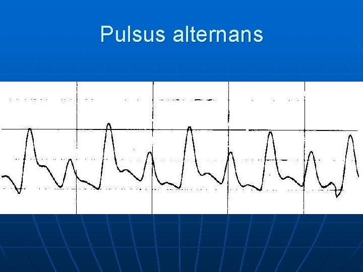 Invasive blood pressure monitoring in critical care Presented