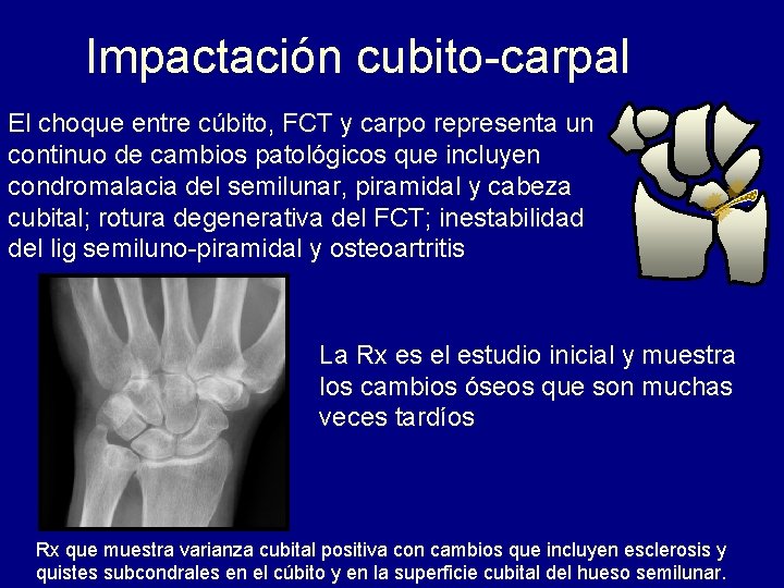 Sndrome de impactacin en el lado cubital de