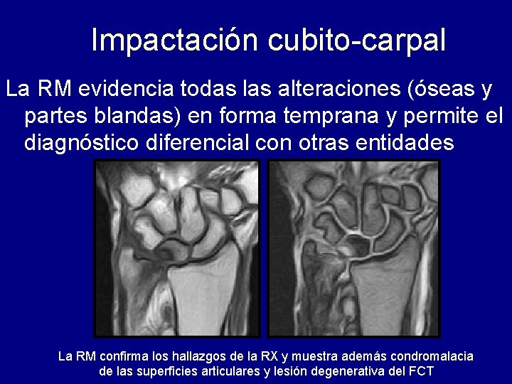 Sndrome de impactacin en el lado cubital de