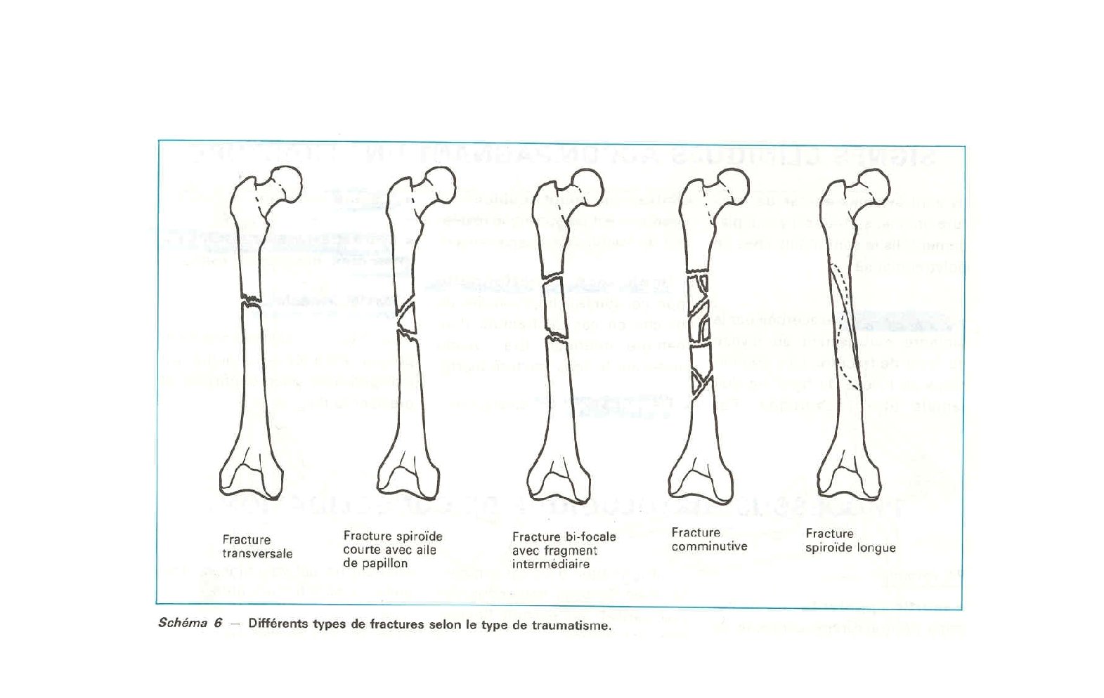 GENERALITES SUR LES FRACTURES Dfinition Fracture solution de