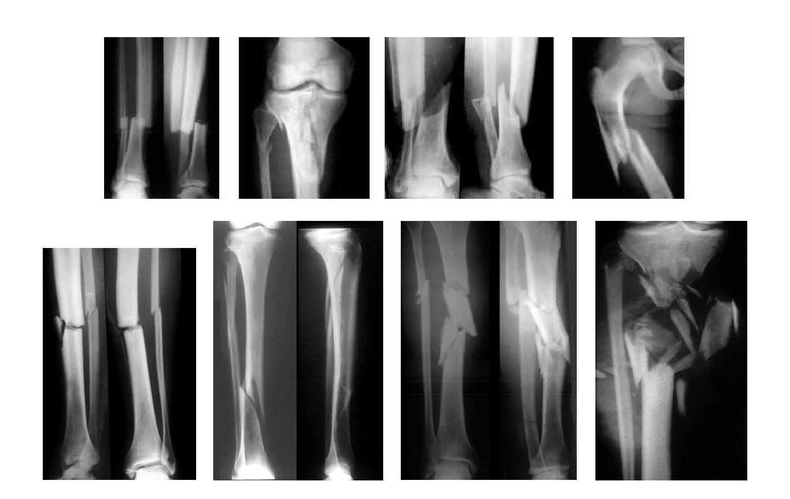 GENERALITES SUR LES FRACTURES Dfinition Fracture solution de
