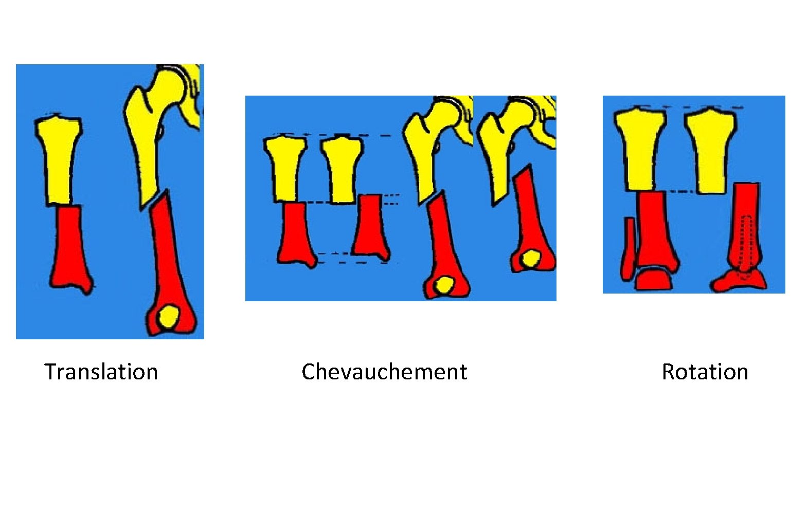 GENERALITES SUR LES FRACTURES Dfinition Fracture solution de