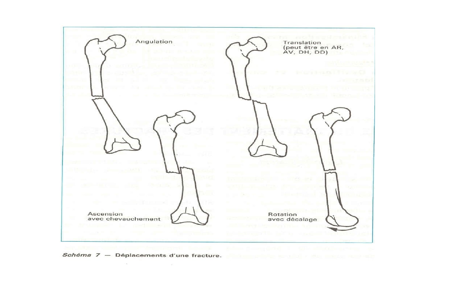 GENERALITES SUR LES FRACTURES Dfinition Fracture solution de