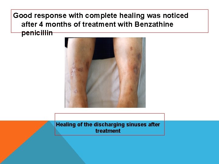 PRIMARY CUTANEOUS ACTINOMYCOSIS FIRST CASE REPORT FROM KURDISTAN