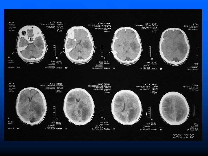 Surgical Pathological Conference Infective Endocarditis with Brain ...
