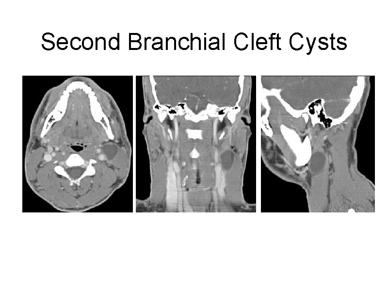 Branchial Cleft Cysts David M Chaky MD Dept