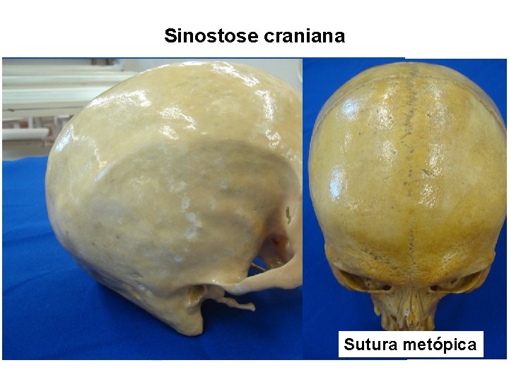 ANATOMIA TOPOGRFICA DA CABEA AULA 1 Introduo Ossos