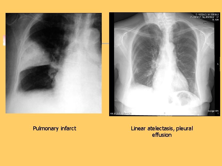 Pulmonary Thromboembolism Prof Sevda zdoan MD Chest Diseases