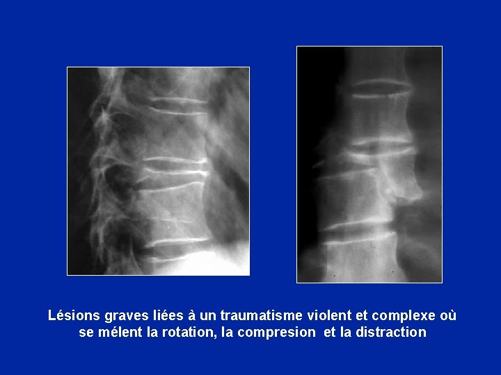 Fractures Dorsales et Lombaires Fractures du rachis Frquence