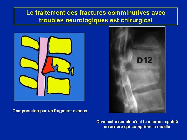 Fractures Dorsales et Lombaires Fractures du rachis Frquence