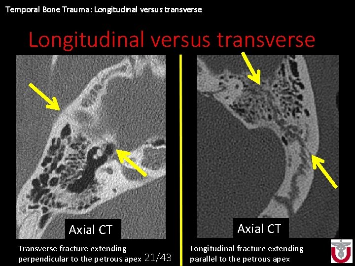 Temporal Bone Trauma What The Radiologist Needs To