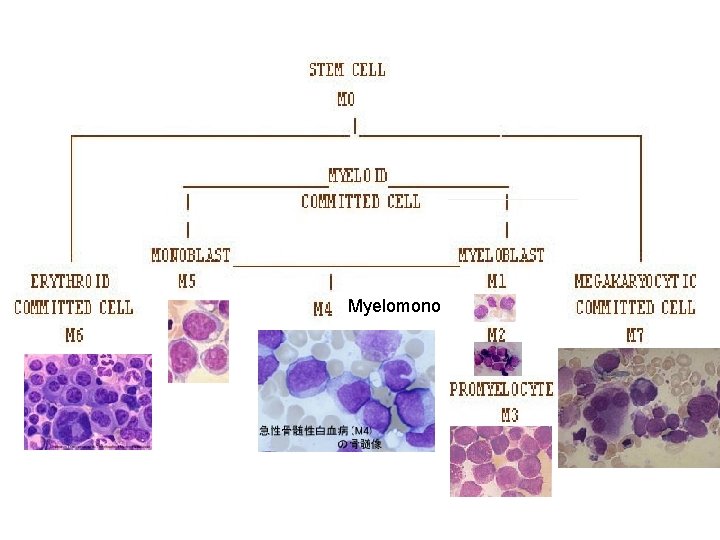 Acute Leukemia Rakesh Biswas MD Professor Department of