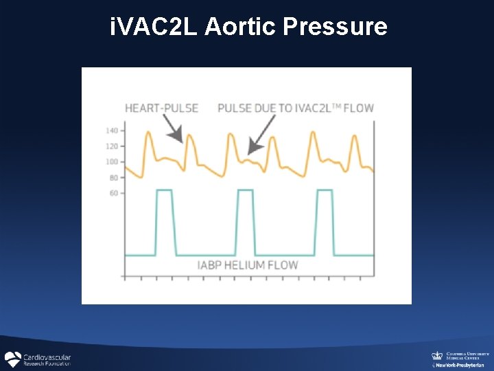 Hemodynamic Talk New Mechanical Circulatory Support for High