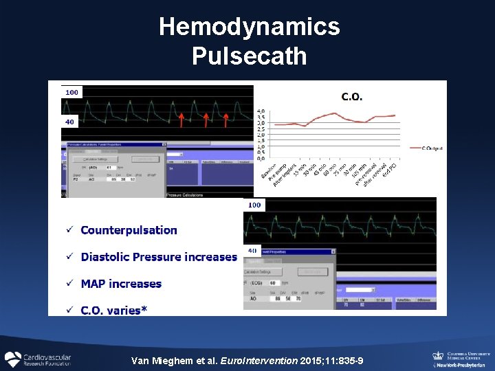 Hemodynamic Talk New Mechanical Circulatory Support for High
