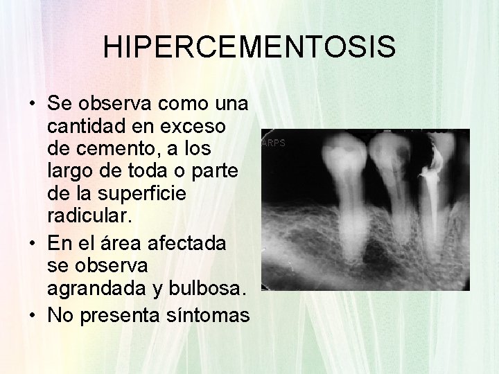 LESIONES RADIOPACAS LESIONES RADIOPACAS PERIAPICALES LESIONES ...