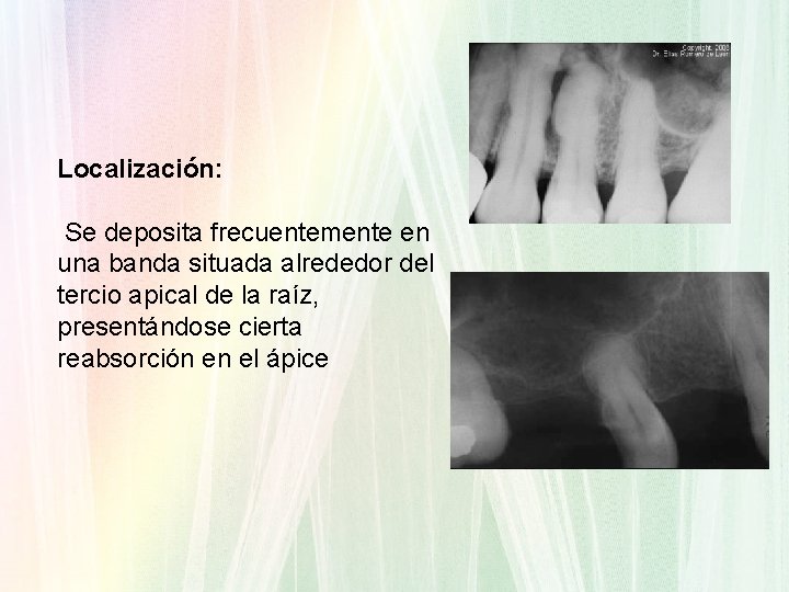 LESIONES RADIOPACAS LESIONES RADIOPACAS PERIAPICALES LESIONES ...