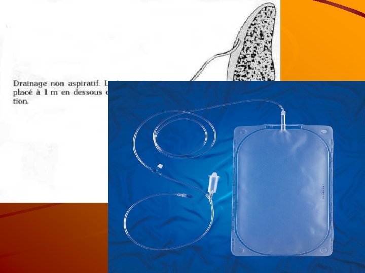 LA PONCTION PLEURALE Soins Infirmiers LA PLVRE La