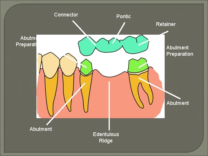 Parts of Fixed Dental Prosthesis Dr Muhammad Rizwan